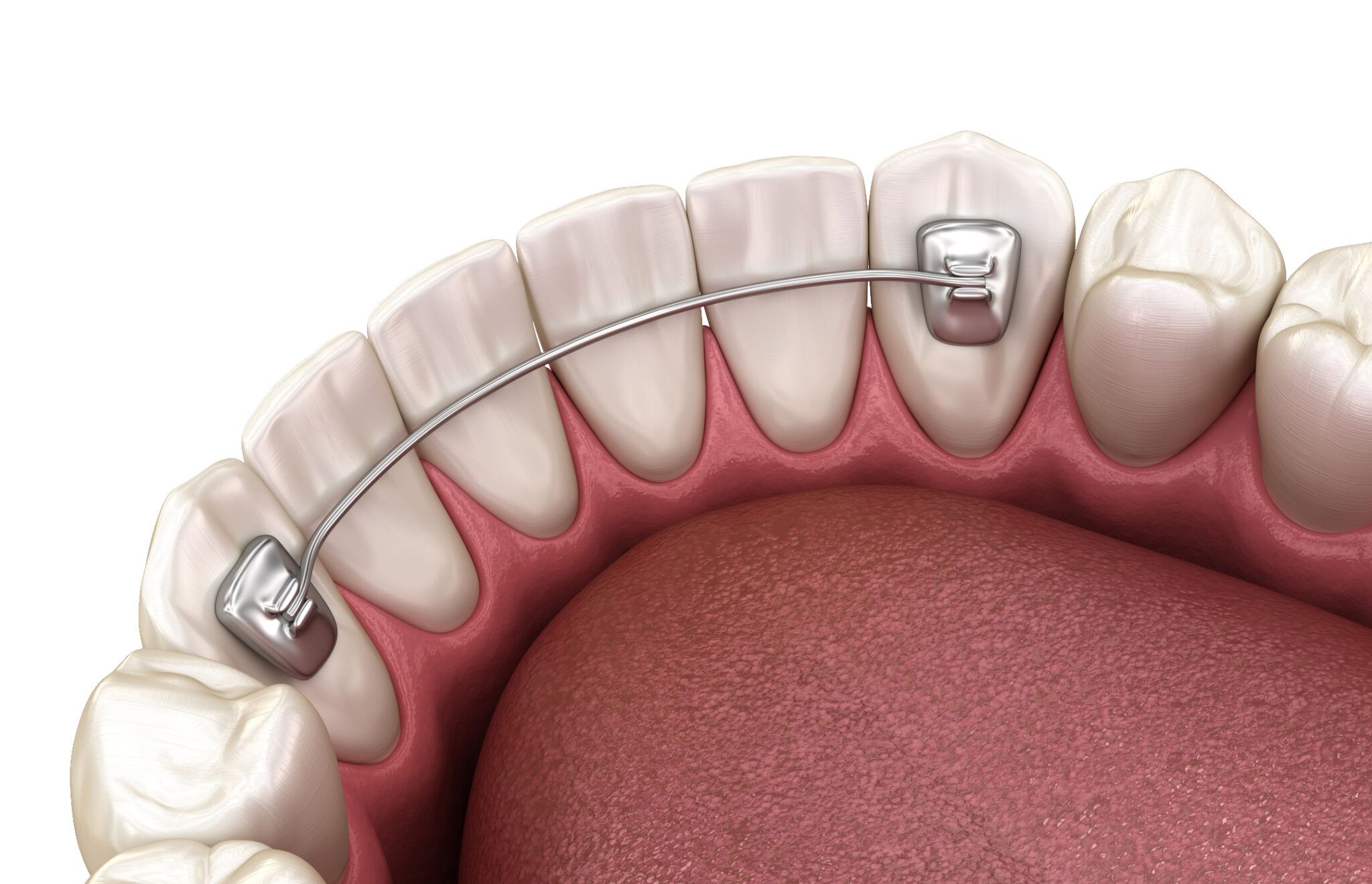 ¿Qué son los retenedores post-ortodoncia? - IMaxilodental ¿Qué son los ...